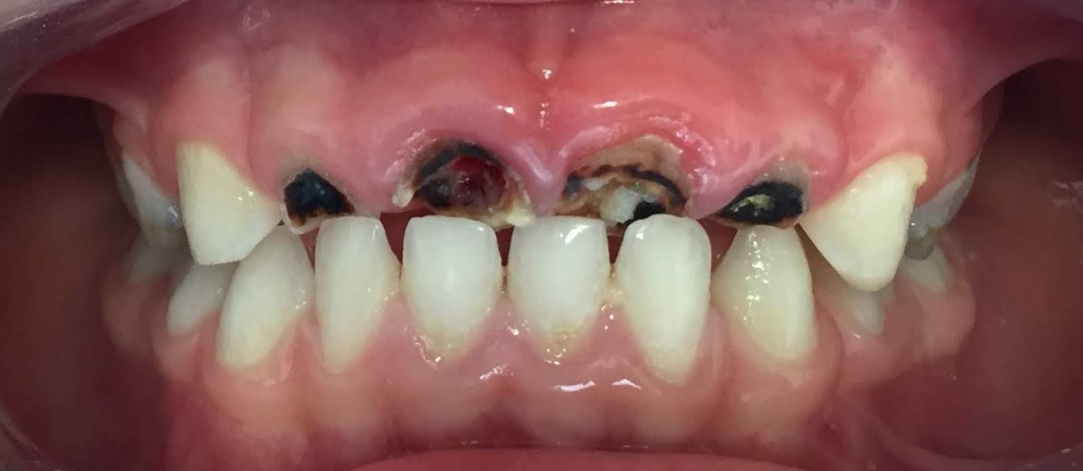 Baby bottle caries and risk factors | BOJ Paediatric Dentistry BCN