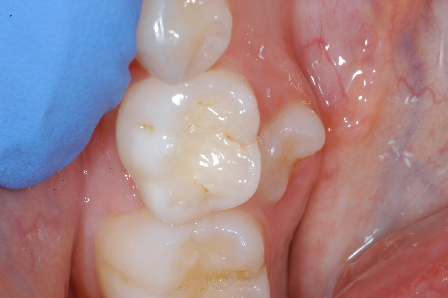 Erupción ectópica de premolares: presentación de un caso | Clínica BOJ