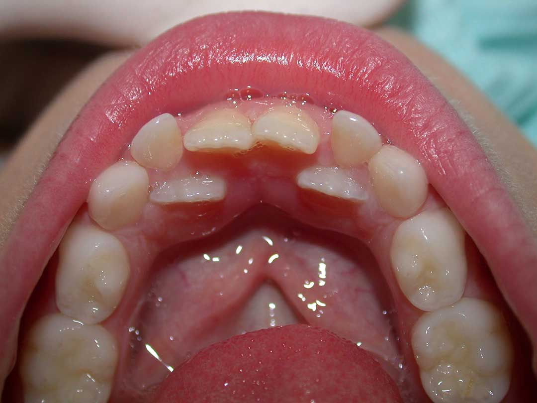 Dos filas de dientes: causas y tratamiento? | BOJ Odontopediatría