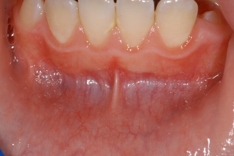 Frenillo Labial: problemas y tratamientos | Dr. BOJ Odontopediatría