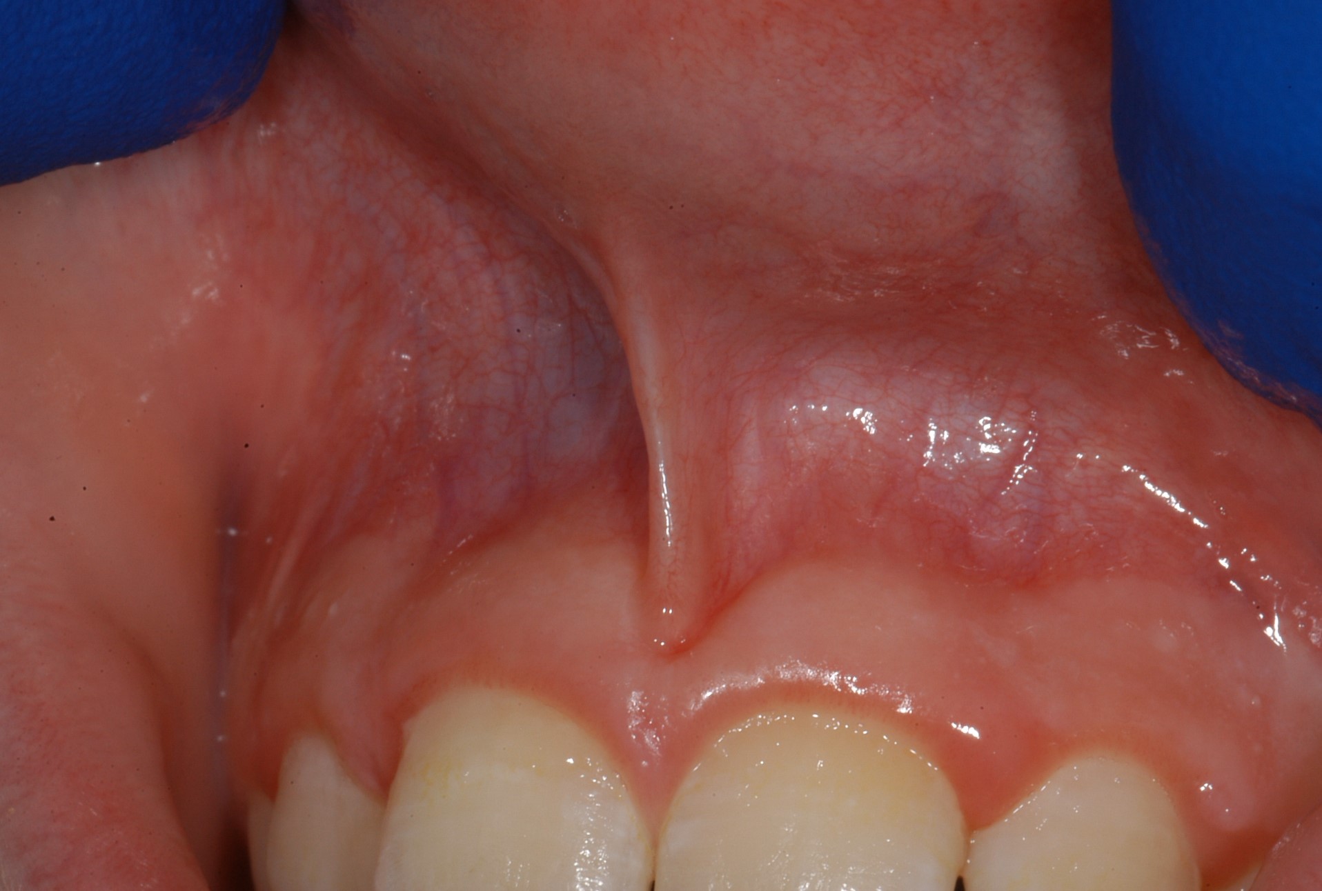 Frenillo Labial: problemas y tratamientos | Dr. BOJ Odontopediatría