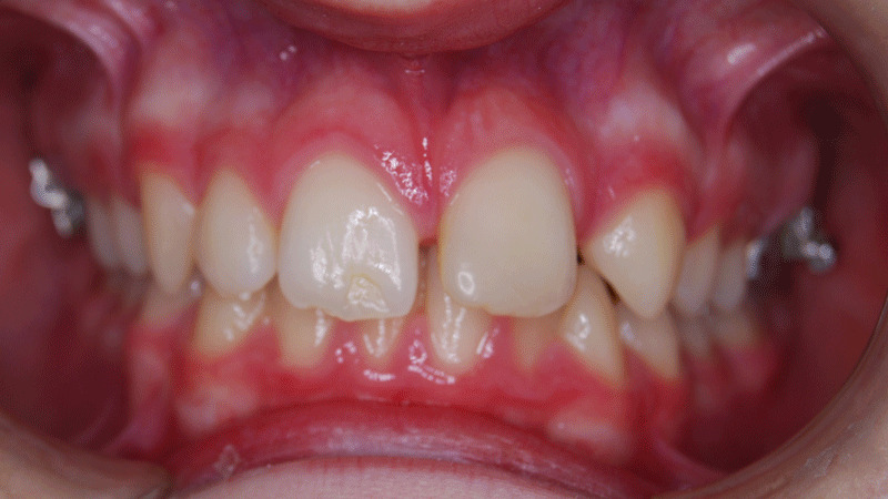 Sobremordida: ¿qué provoca y tratamiento? | BOJ Odontopediatría