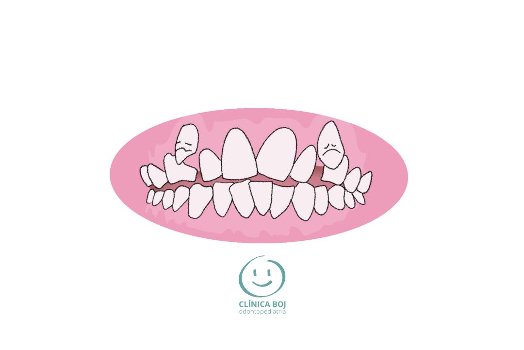 Crowded Teeth